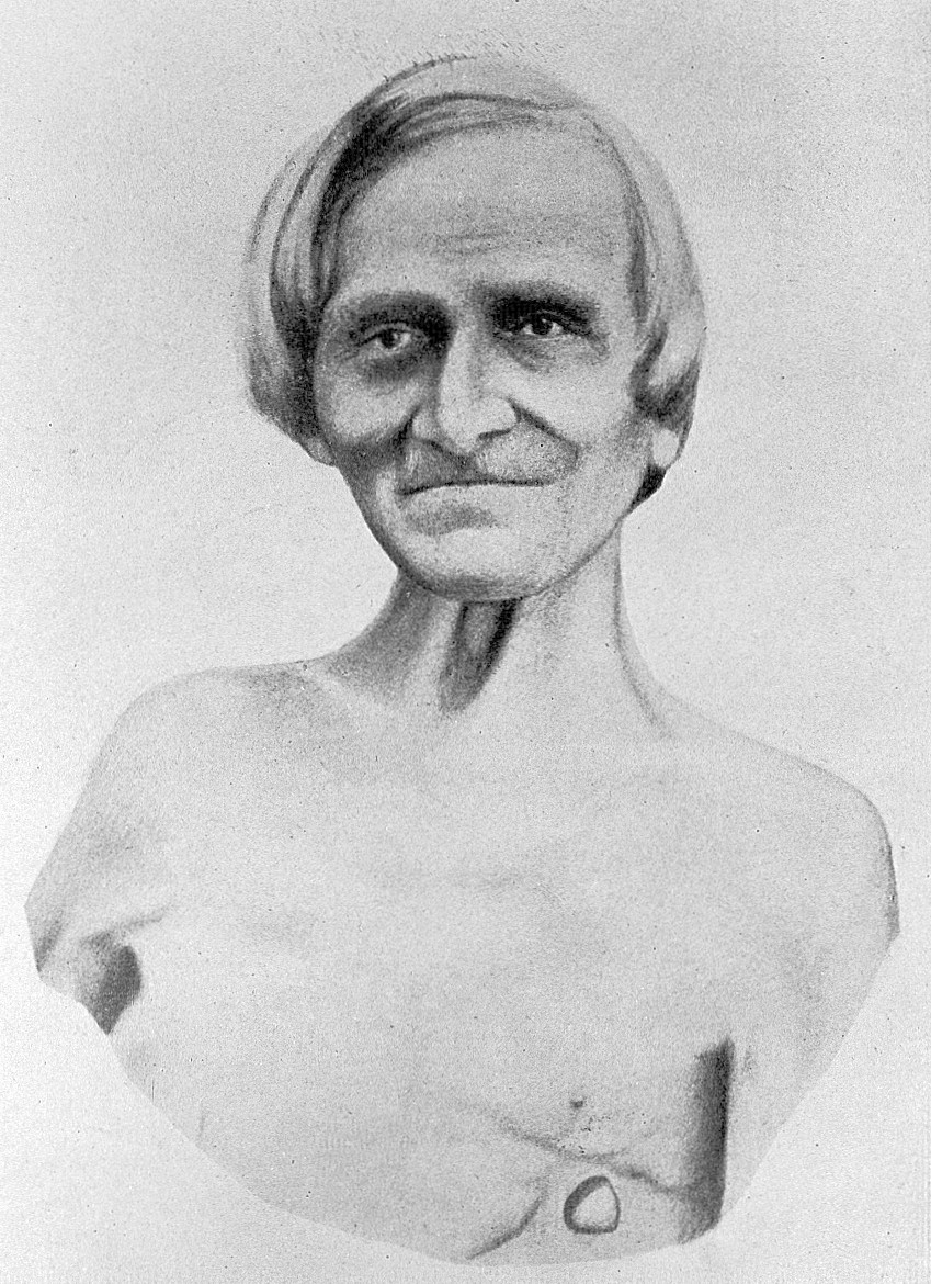 Alexis St. Martin: The Man With A Hole In His Stomach - Mysterious Michigan