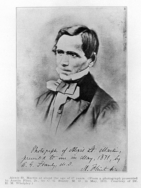 Alexis St. Martin: The Man With A Hole In His Stomach | Mysterious Michigan